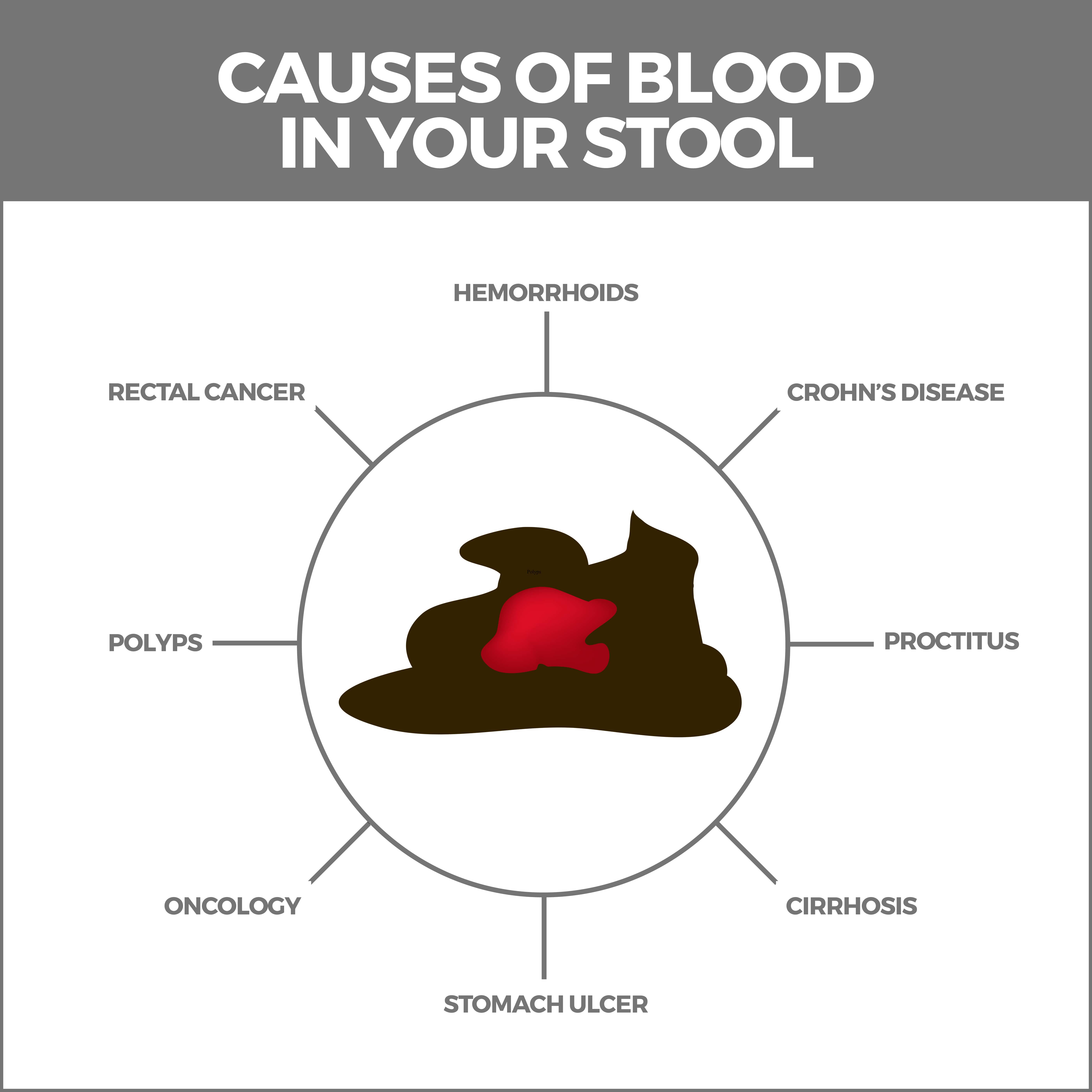 Internal Bleeding Stool Symptoms