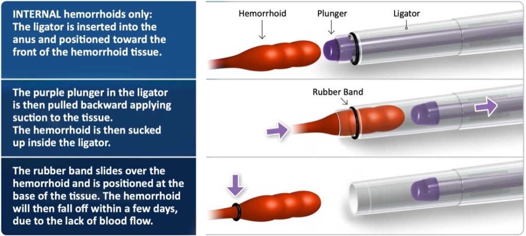Hemorrhoid Banding - United Digestive