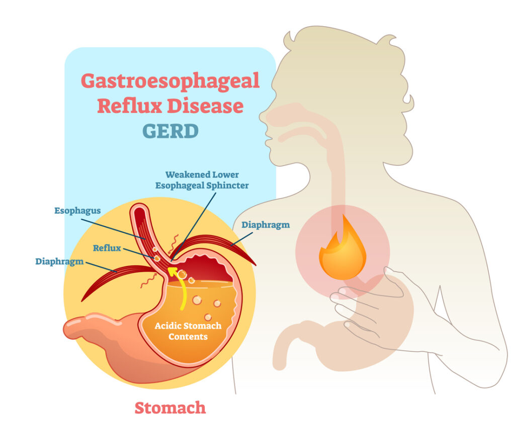 Managing GERD: Lifestyle and Dietary Tips for Relief - United Digestive